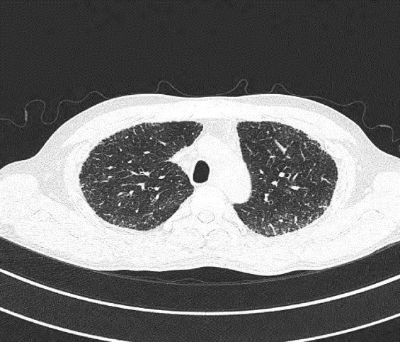 The Scouring Sponge Lung - Fibrosis paru idiopatik | Bali Tribune
