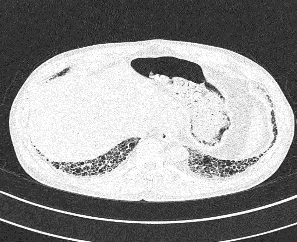 The Scouring Sponge Lung - Fibrosis paru idiopatik | Bali Tribune